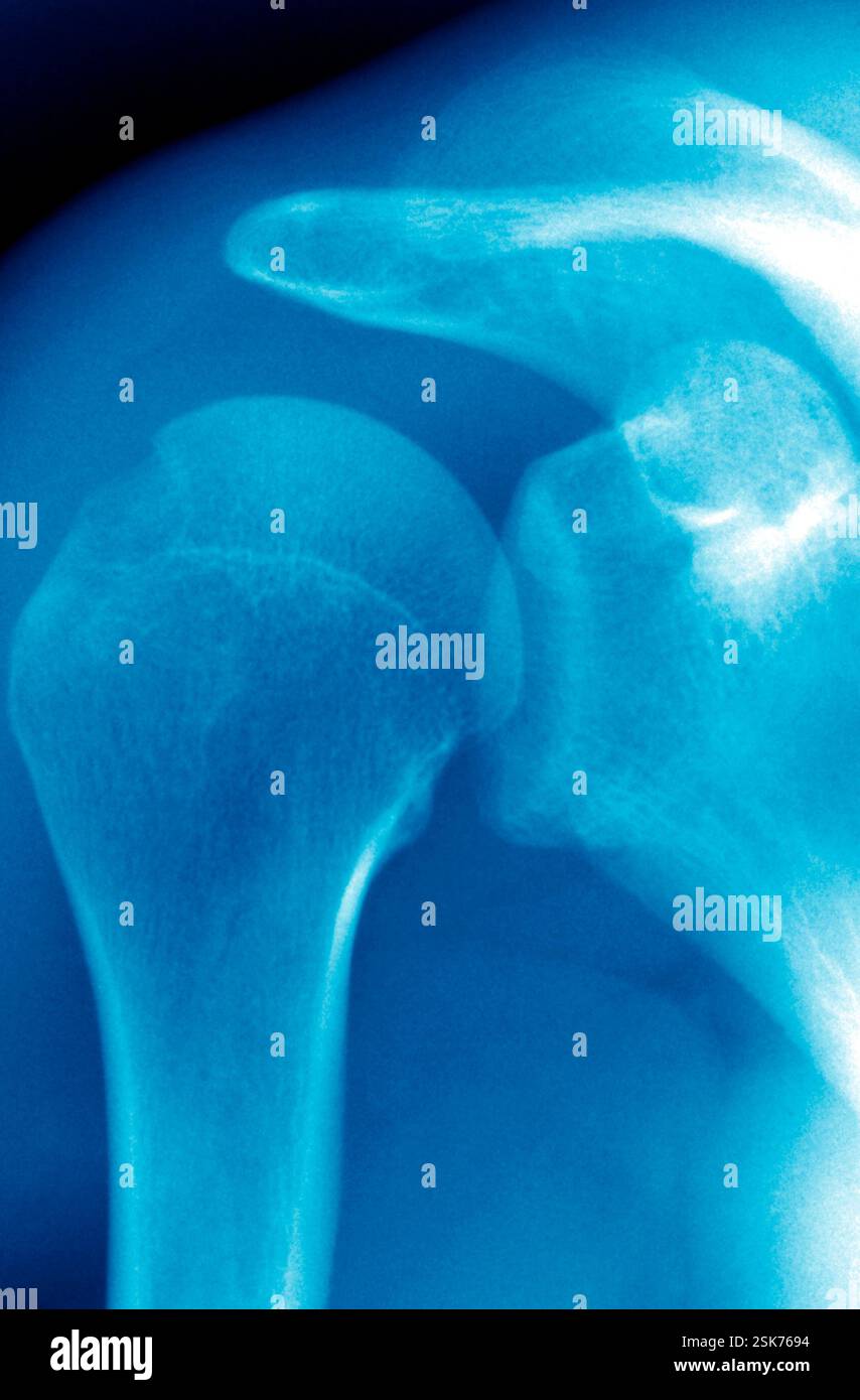 Dislocated shoulder. Coloured frontal X-ray of the bones of a ...