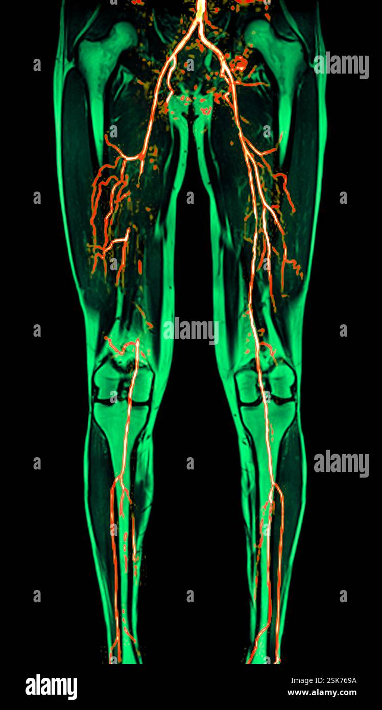 Eyes, optic nerves and brain, MRI scan Stock Photo - Alamy