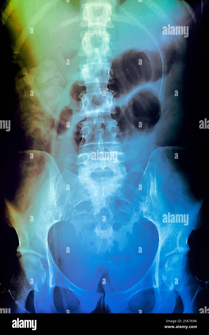 Occluded intestine, coloured X-ray. This front-on abdominal X-ray was ...