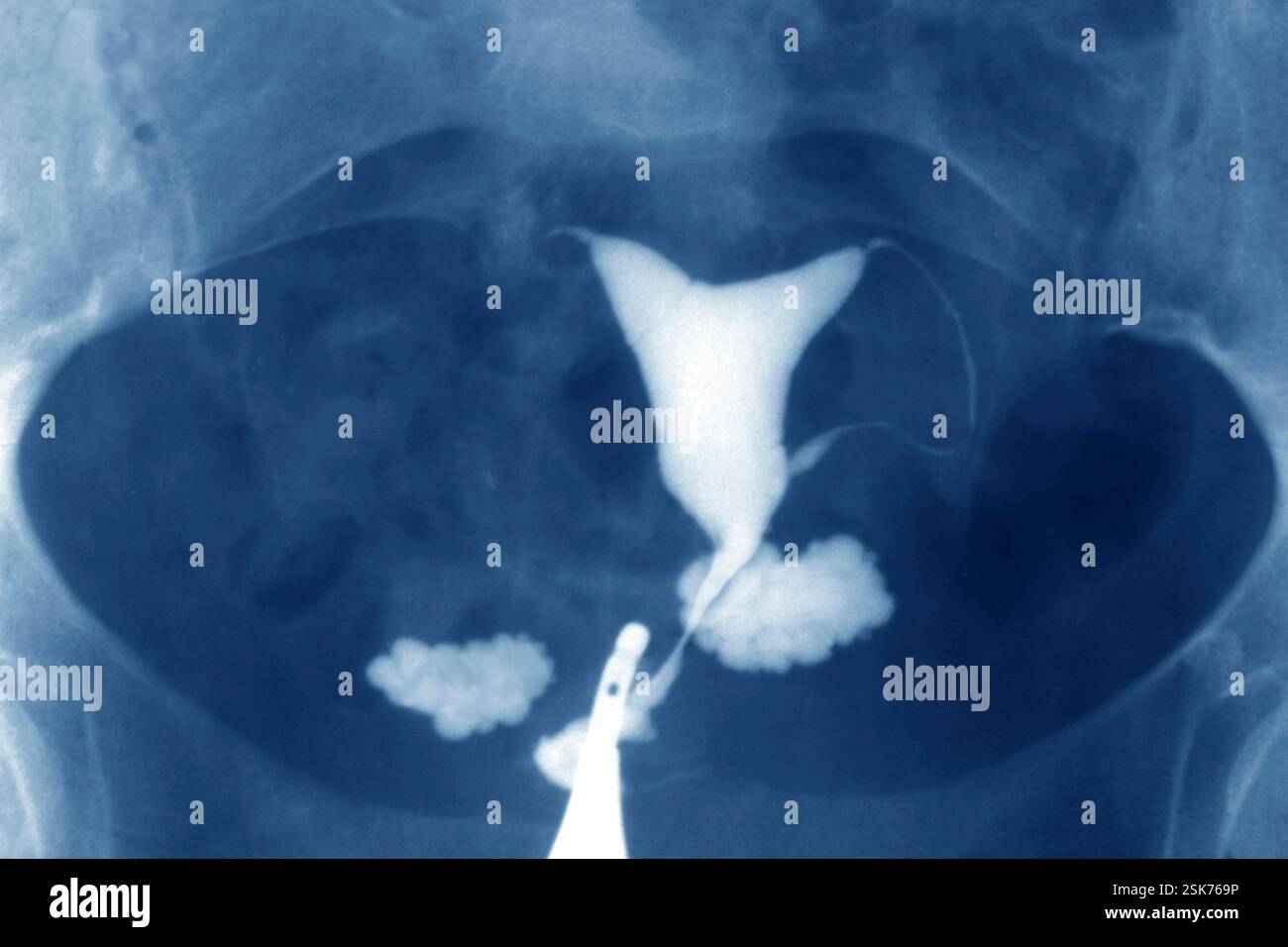 Blocked fallopian tubes. Coloured hysterosalpingogram (X-ray) of a ...