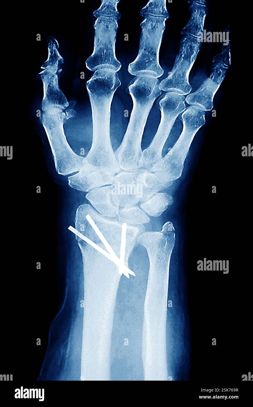 Pinned wrist fracture. Coloured X-ray of a pinned fracture of the wrist ...