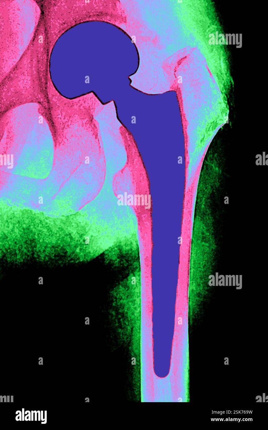 Artificial hip. Coloured frontal X-ray of the hip bones (red) and ...