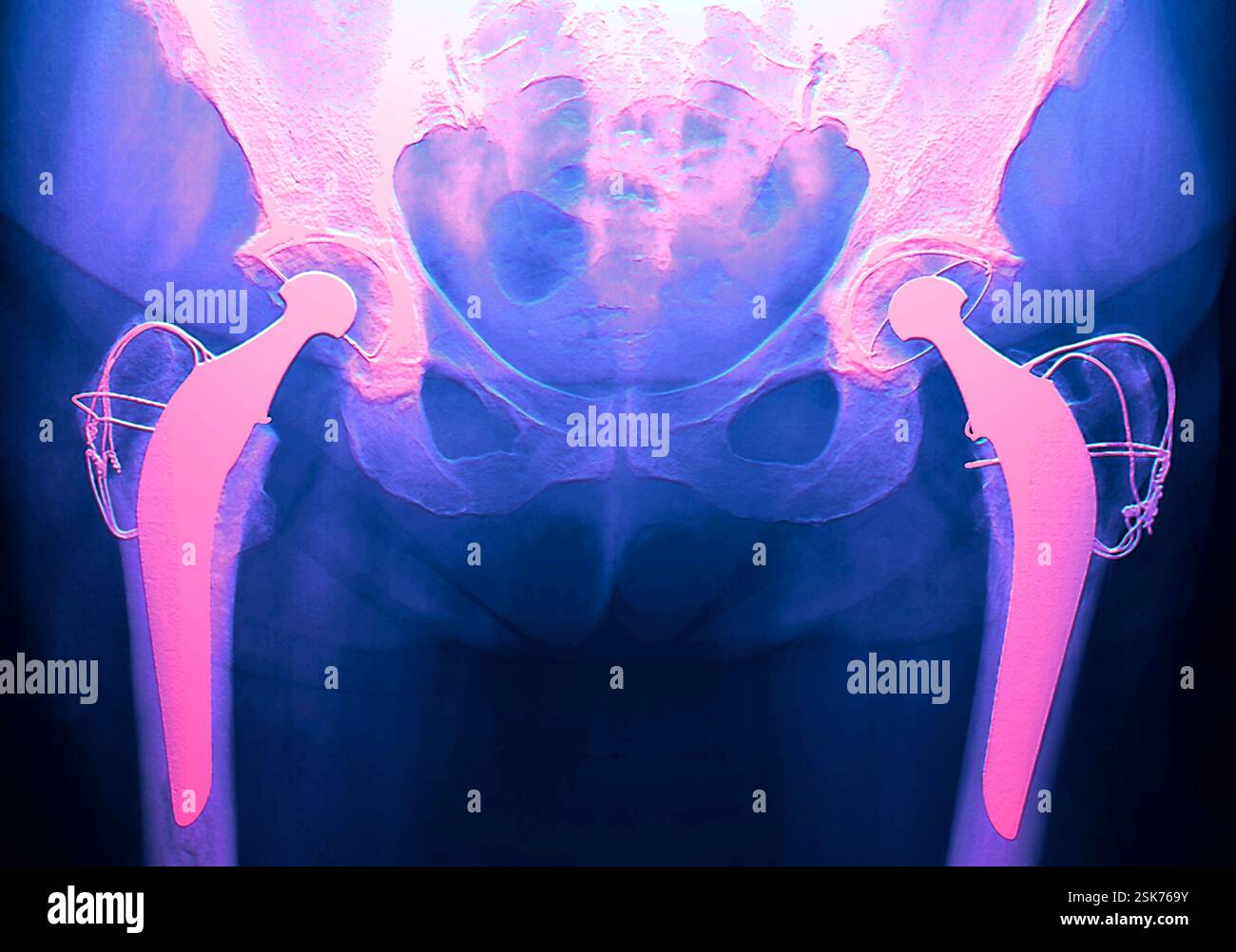 Artificial hips, X-ray Stock Photo - Alamy