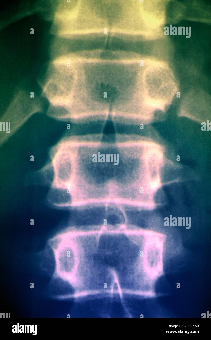 Spine in spina bifida. Coloured frontal X-ray of part of the spine of a ...