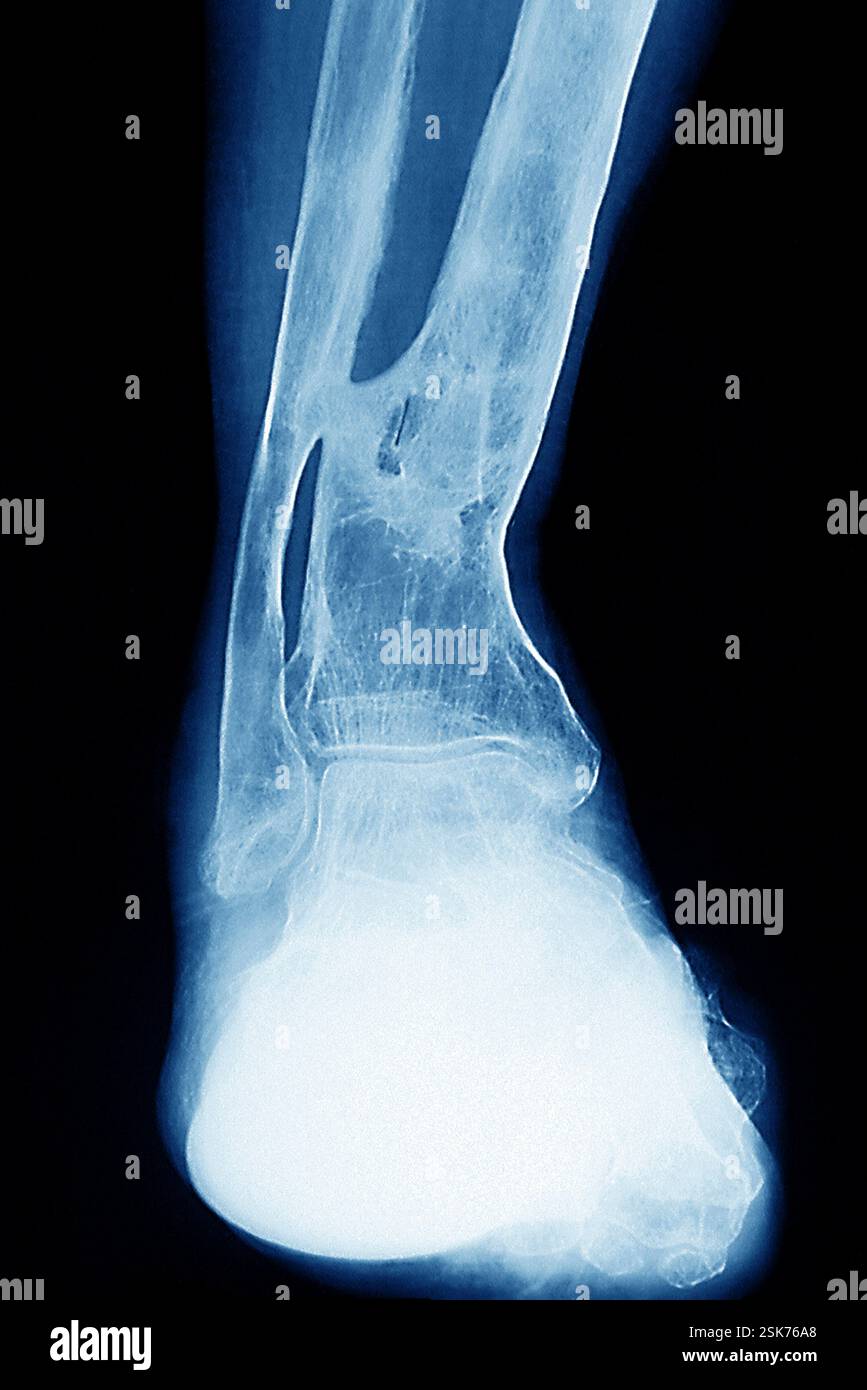 Fused ankle bones. Coloured frontal X-ray of the fused ankle bones of a 70-year-old woman. The ...