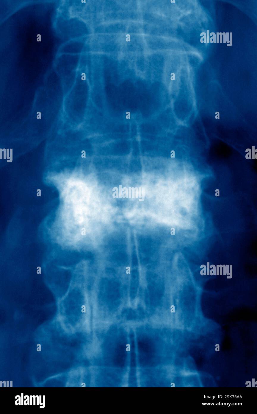 Spinal collapse treatment, X-ray Stock Photo - Alamy