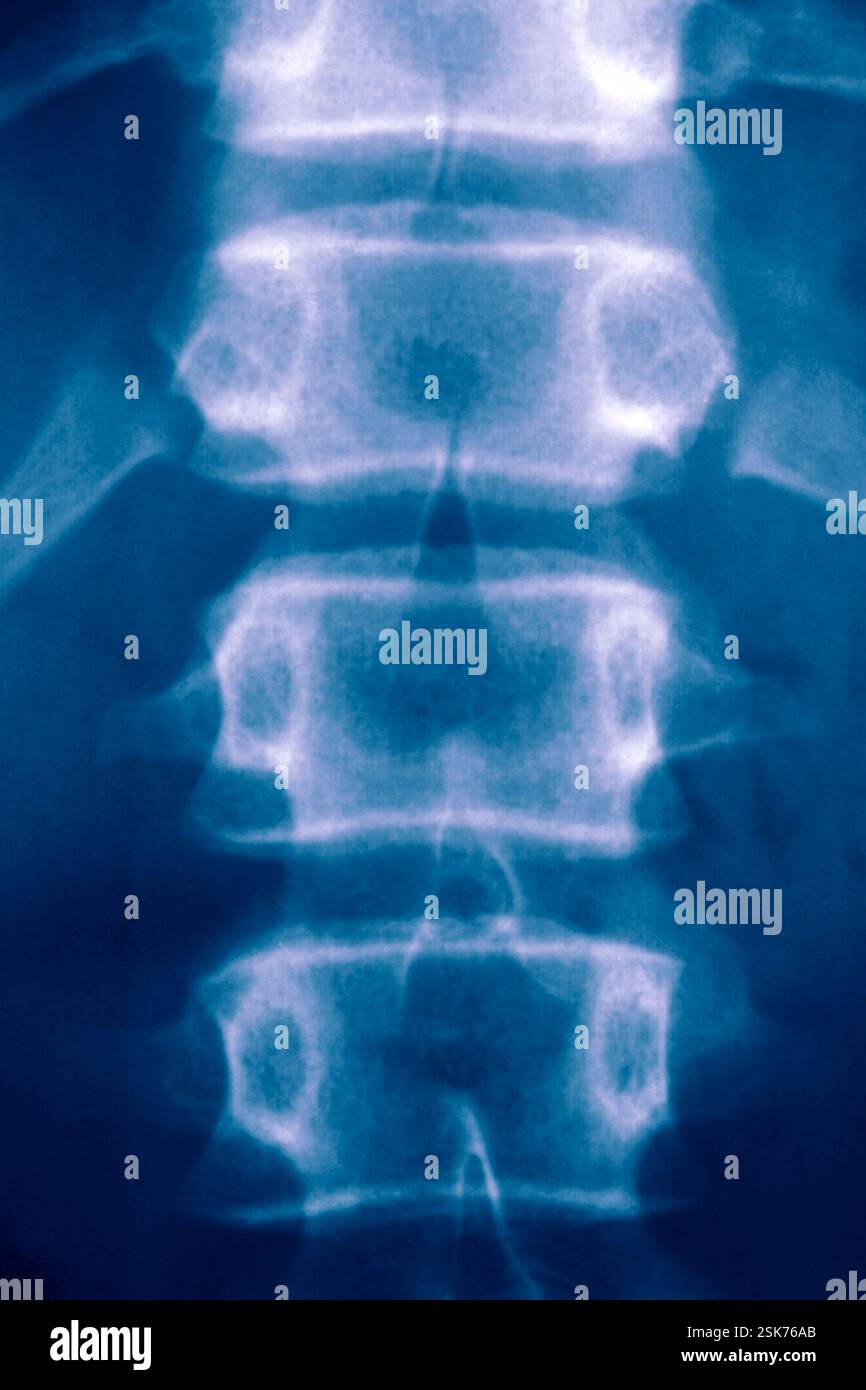 Spine in spina bifida. Coloured frontal X-ray of part of the spine of a ...