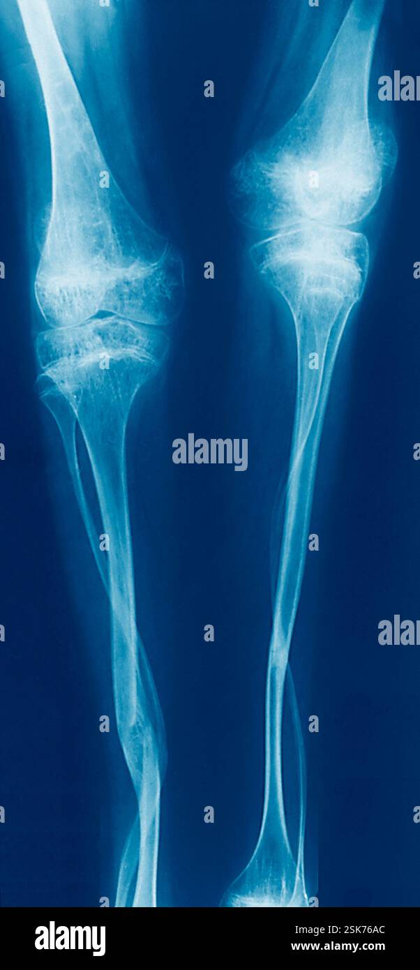 Lobstein's disease. Coloured frontal X-ray of deformed leg bones in a ...
