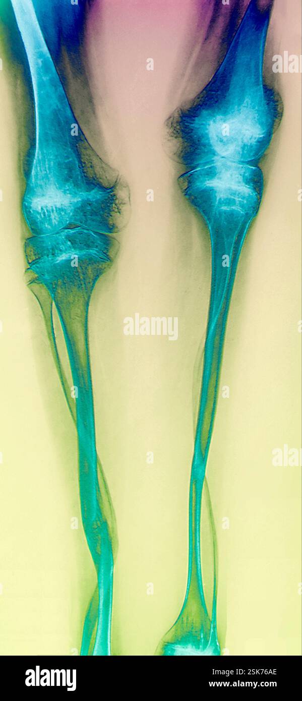Lobstein's disease. Coloured frontal X-ray of deformed leg bones in a ...