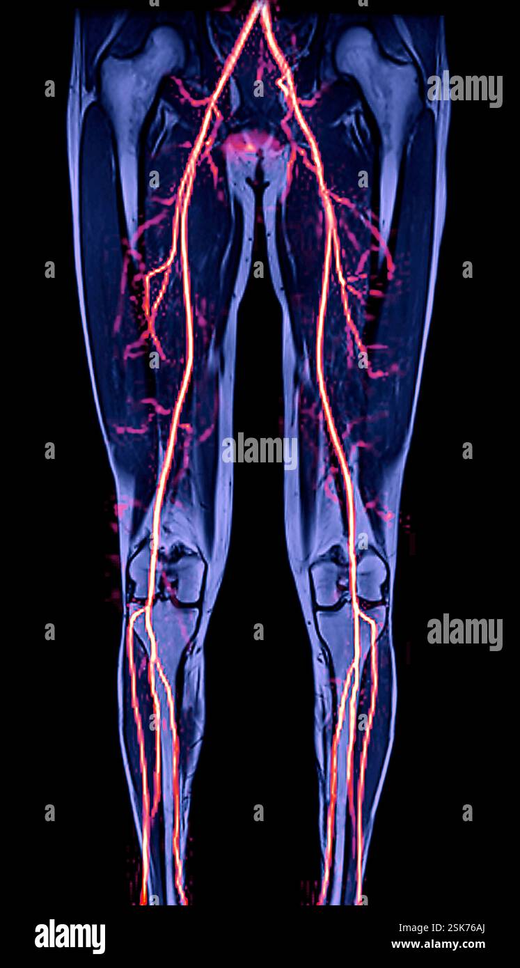 Leg arteries. Coloured magnetic resonance imaging (MRI) scan of normal ...