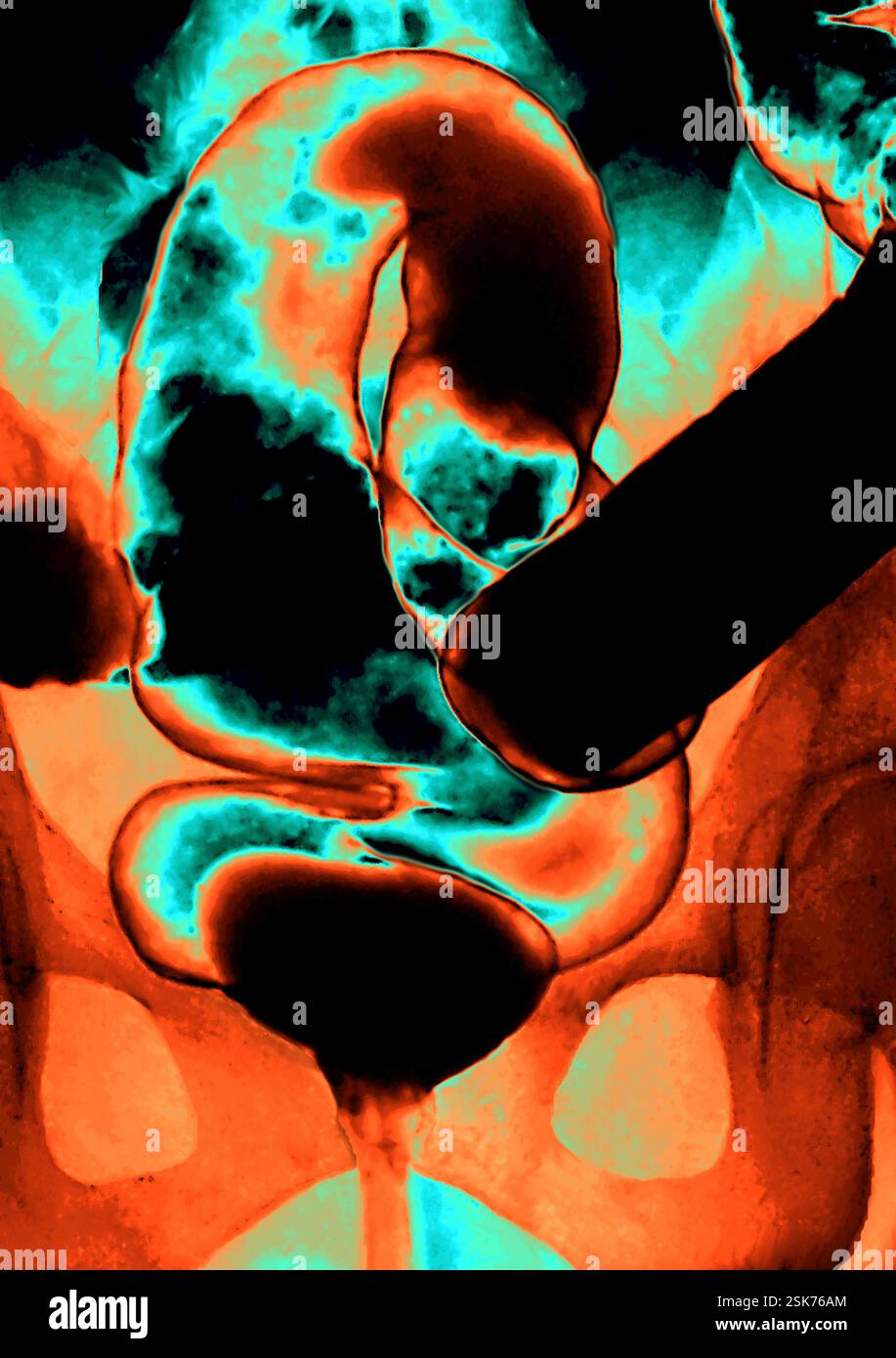 Healthy rectum, coloured double contrast barium X- ray. The rectum (black, lower centre) is the ...