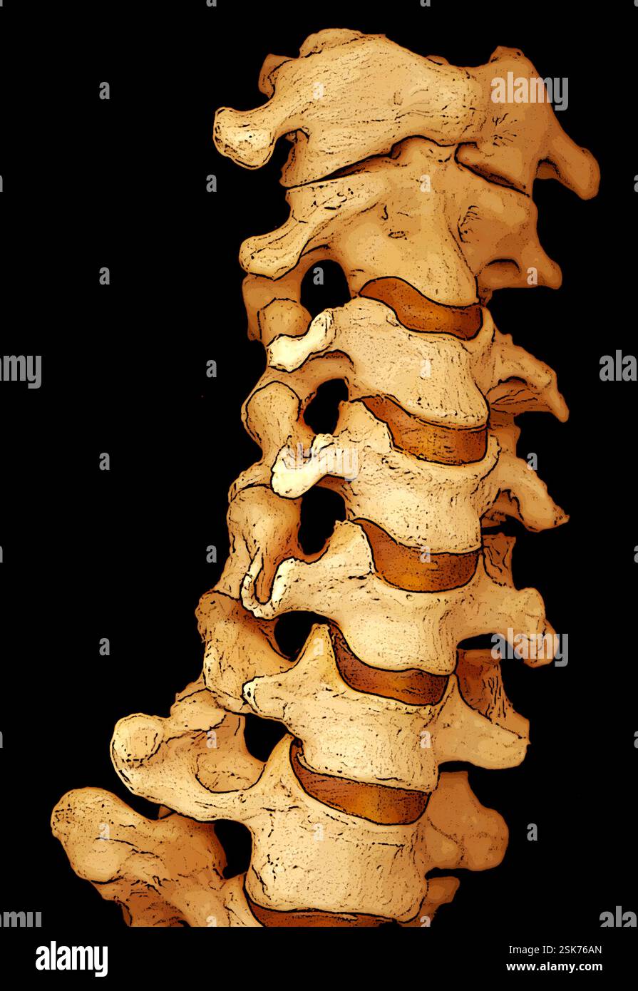Neck bones. Oblique 3D CT (computed tomography) scan of normal neck ...