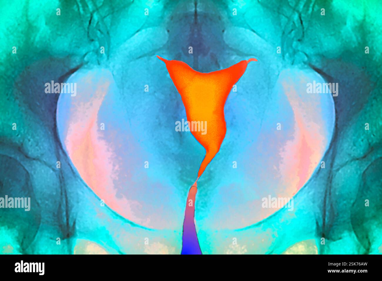 Blocked fallopian tubes, X-ray Stock Photo - Alamy