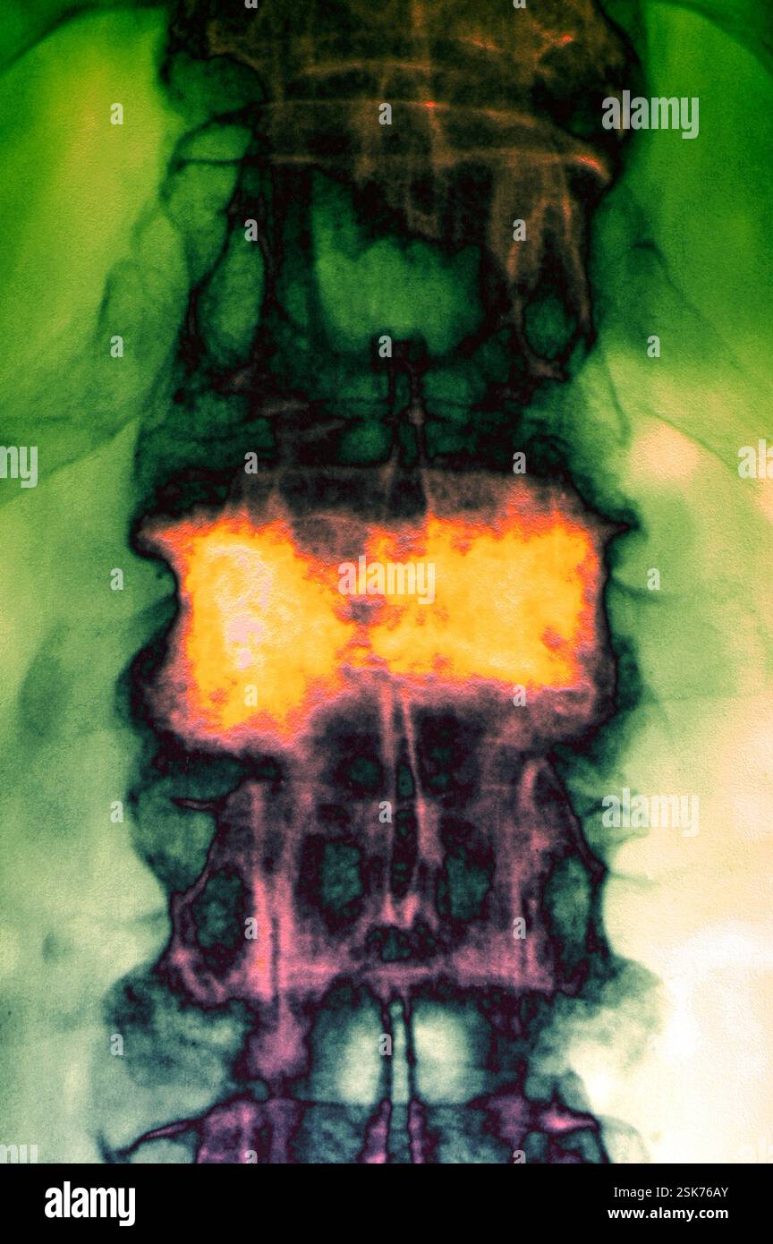 Spinal collapse treatment, X-ray Stock Photo - Alamy