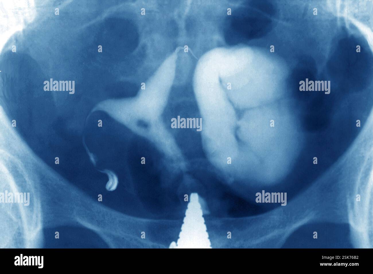 Infected fallopian tube. Coloured frontal hysterosalpingogram X-ray of ...