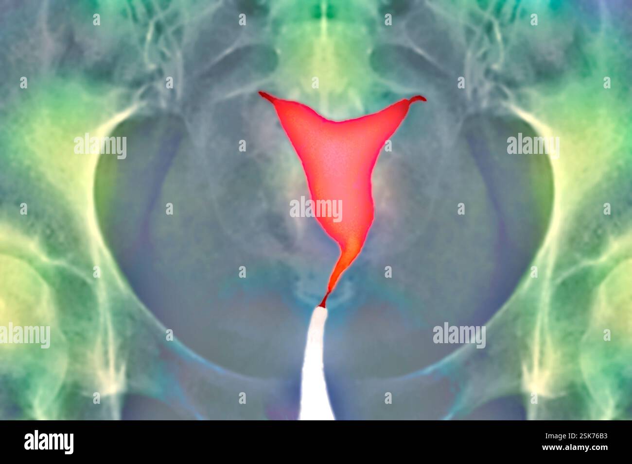Blocked fallopian tubes. Coloured hysterosalpingogram (X-ray) the ...