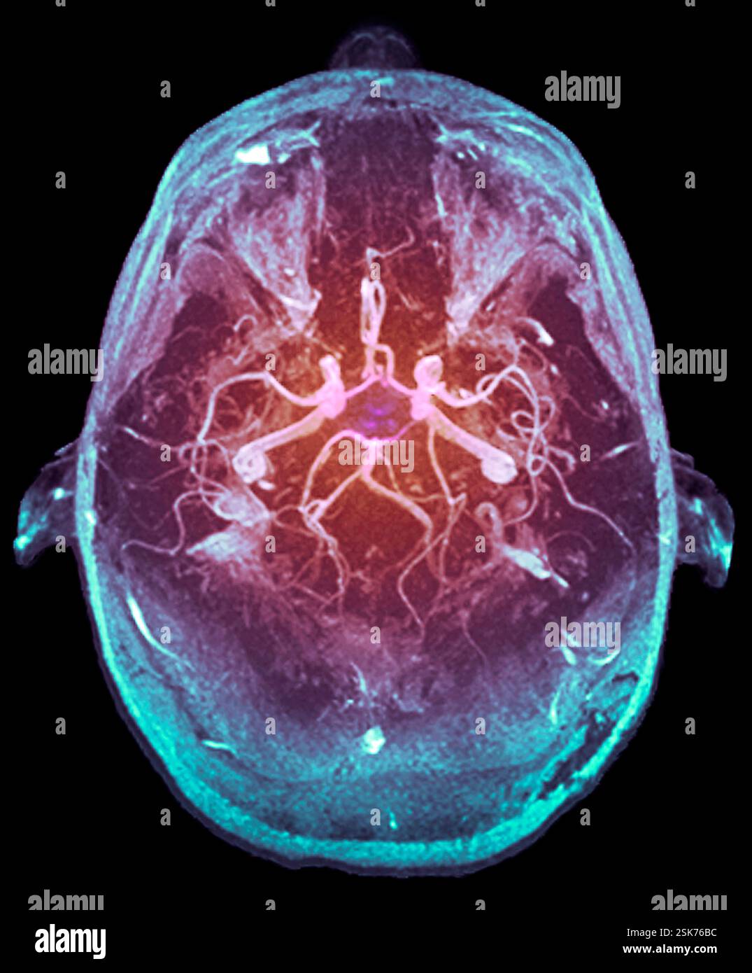 Brain arteries, 3D MRI scan Stock Photo - Alamy