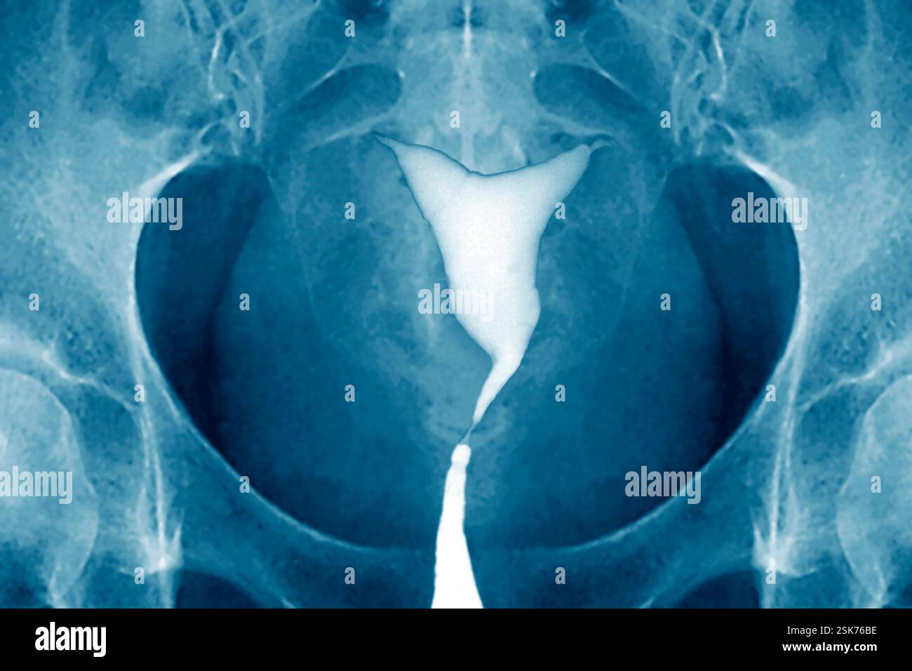 Blocked fallopian tubes. Coloured hysterosalpingogram (X-ray) the ...