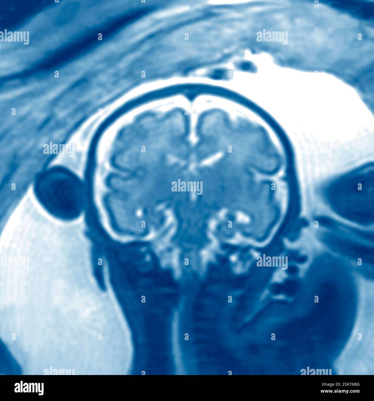 Foetus' brain. Coloured magnetic resonance imaging (MRI) scan of a ...