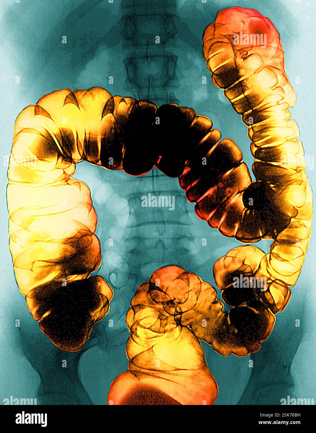 Healthy colon, coloured double contrast barium enema X-ray. The colon ...