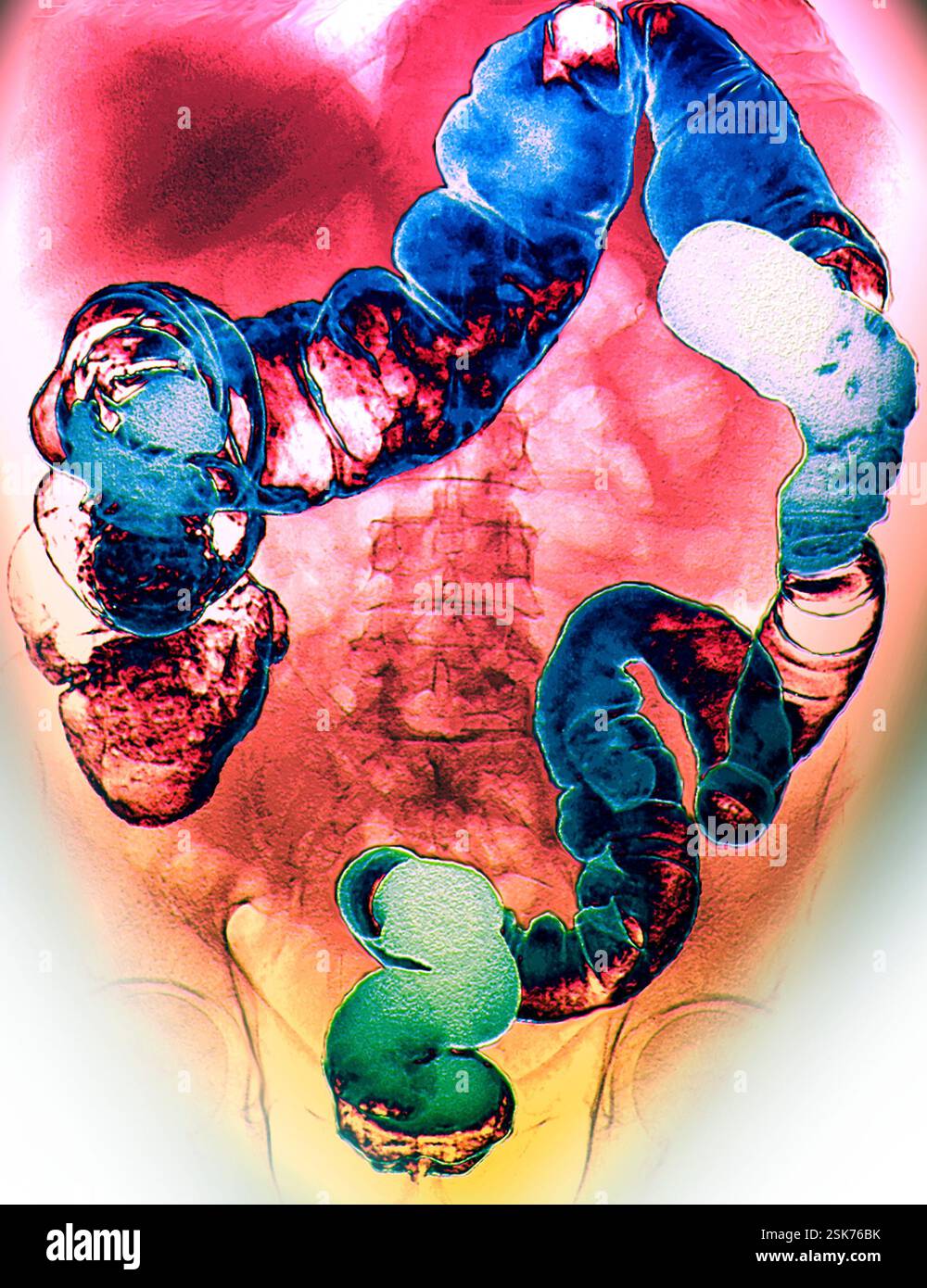 Healthy colon, coloured double contrast barium enema X-ray. The colon ...