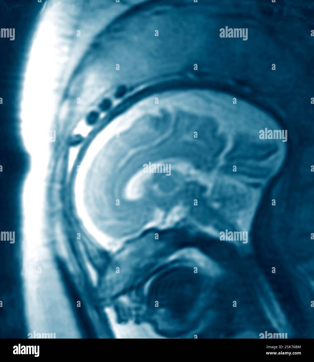 Foetus' brain. Coloured magnetic resonance imaging (MRI) scan of a ...