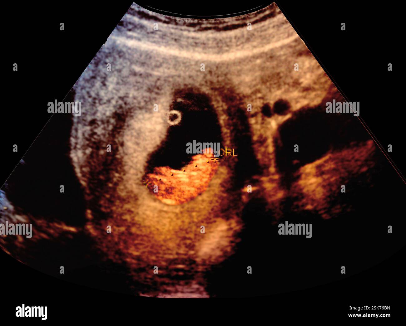 Nine week old foetus. Coloured ultrasound scan of a nine week old ...