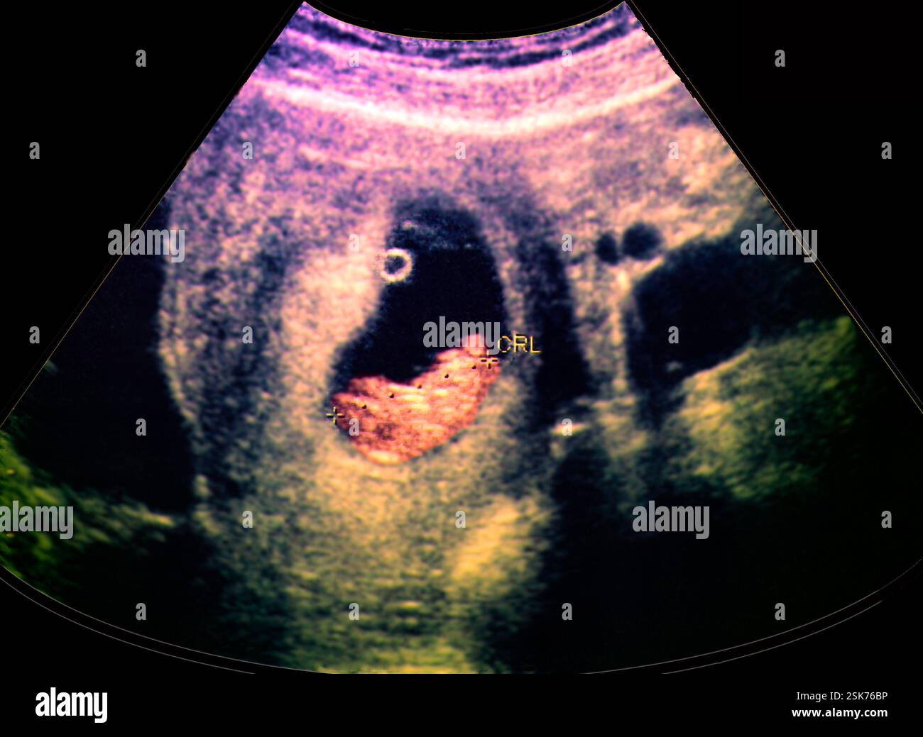 Nine week old foetus. Coloured ultrasound scan of a nine week old ...