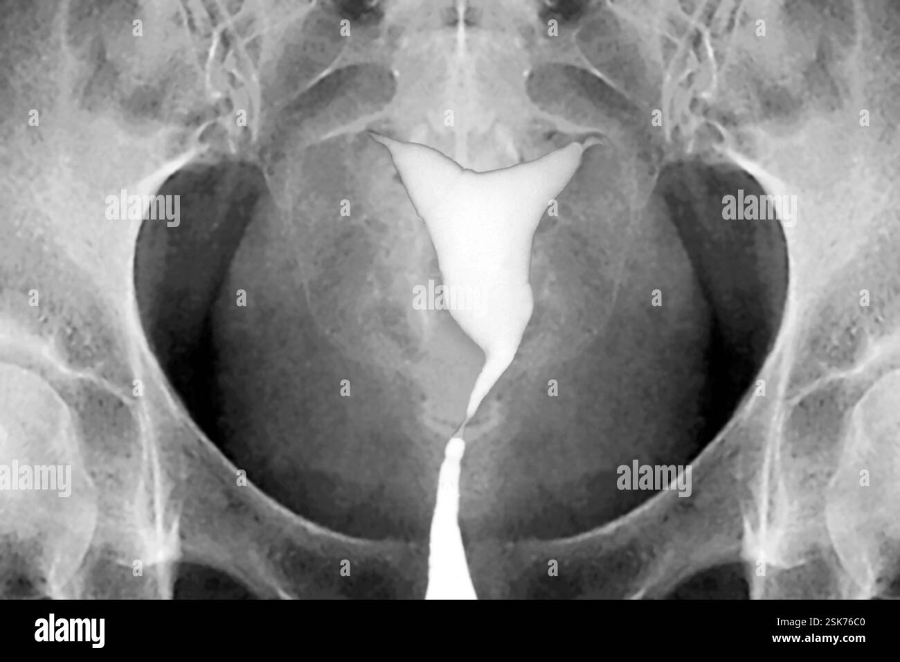 Blocked fallopian tubes, X-ray Stock Photo - Alamy