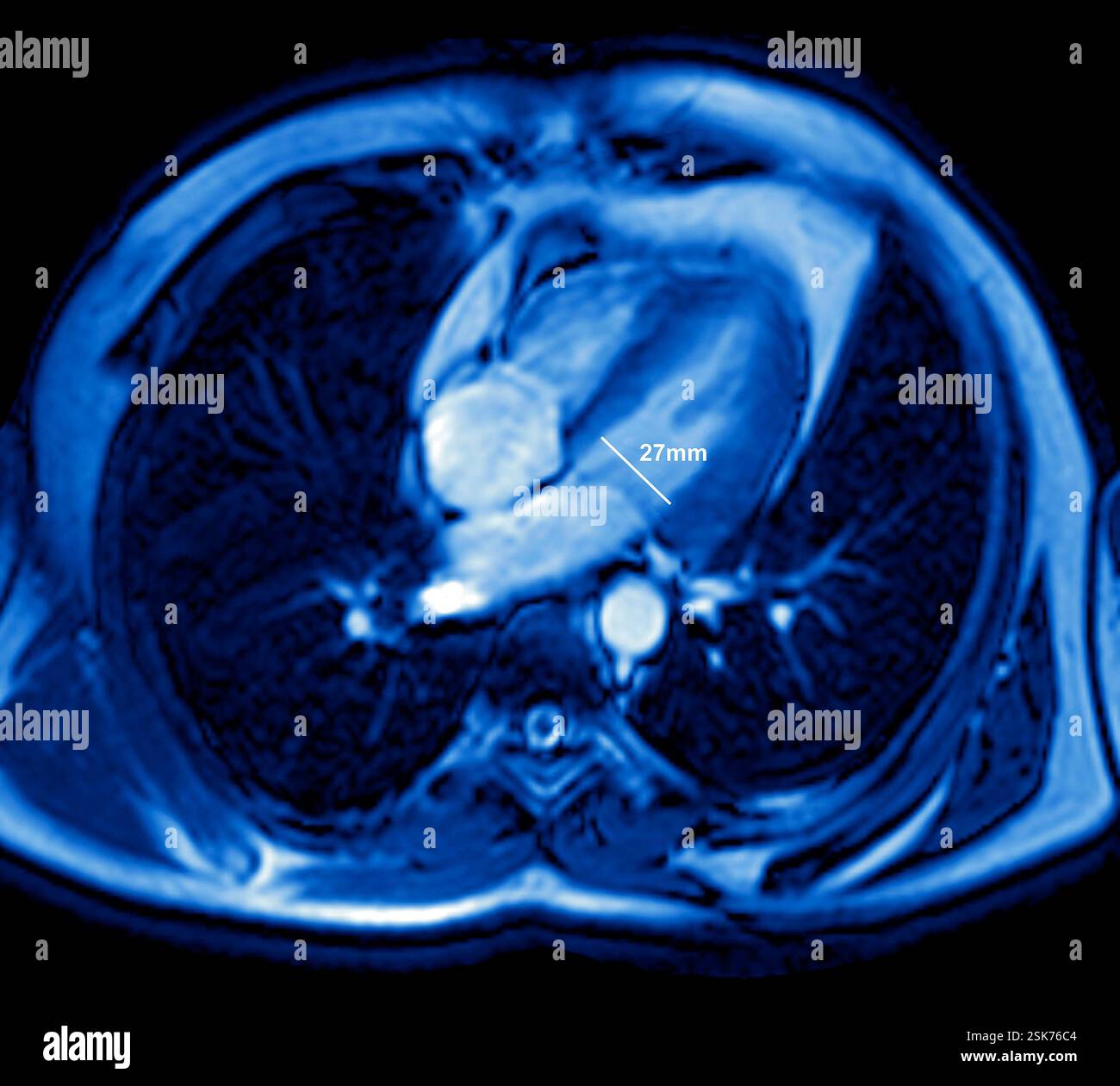 Systolic phase of heartbeat, MRI scan Stock Photo - Alamy