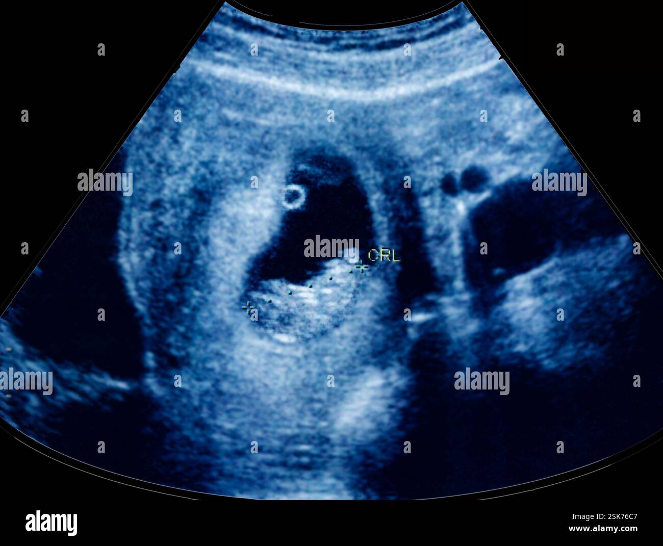 Nine week old foetus. Coloured ultrasound scan of a nine week old ...