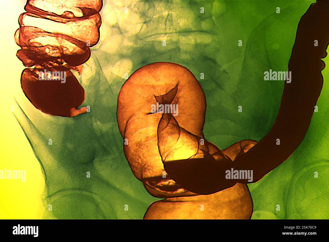 Healthy appendix, coloured double contrast barium enema X-ray. The ...