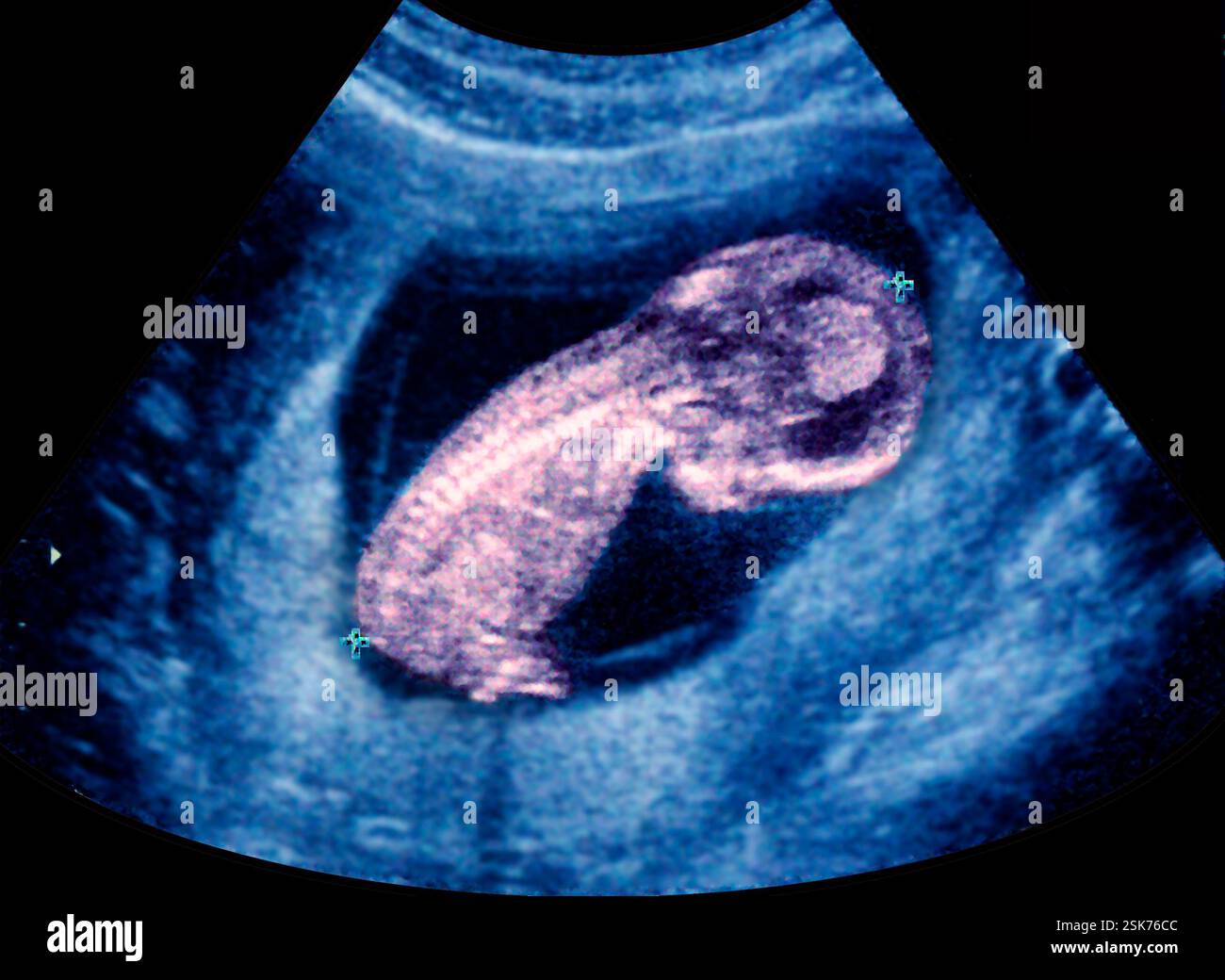 Thirteen week old foetus. Coloured ultrasound scan of a thirteen week ...