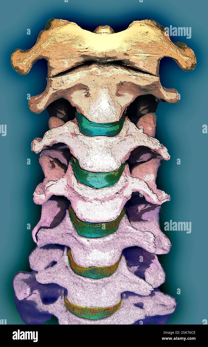 Neck bones. Frontal 3D CT (computed tomography) scan of normal neck ...