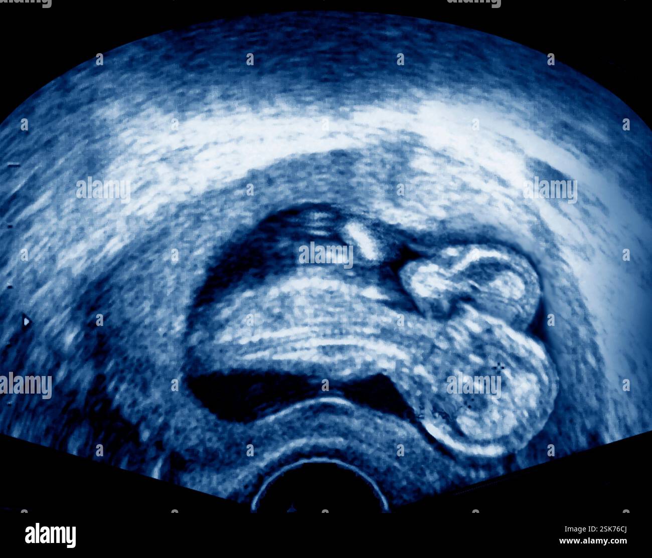 Twin foetuses, ultrasound scan Stock Photo - Alamy