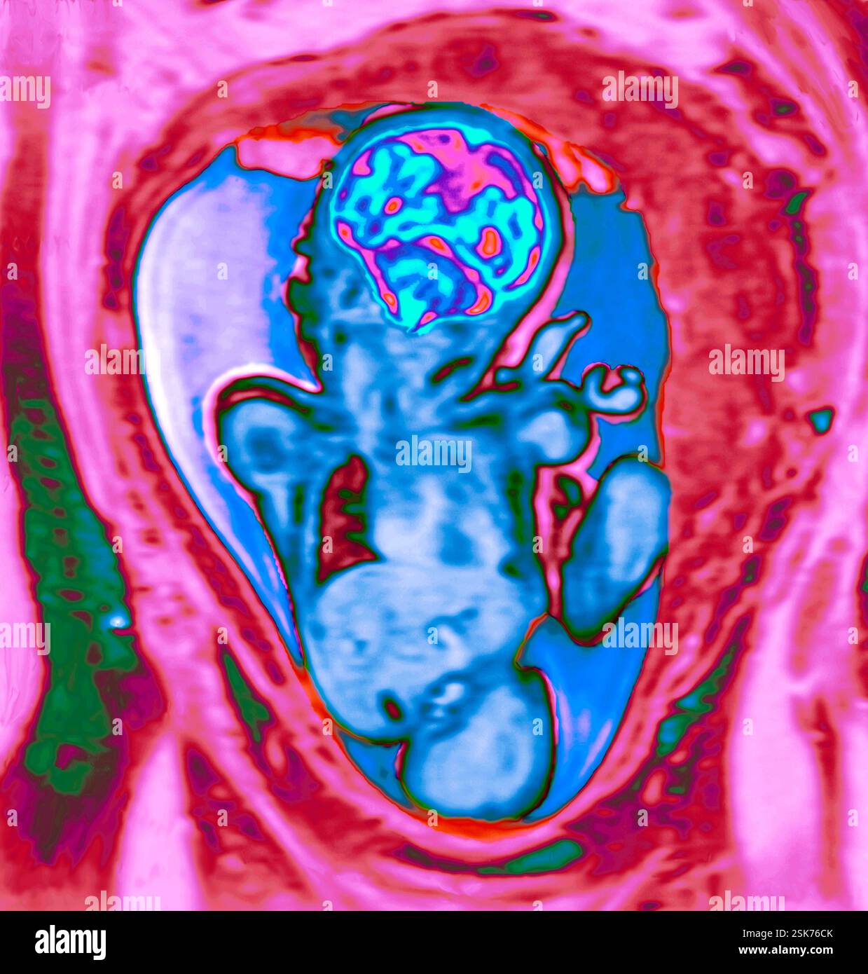 Foetus. Coloured magnetic resonance imaging (MRI) scan of a 25 week old ...