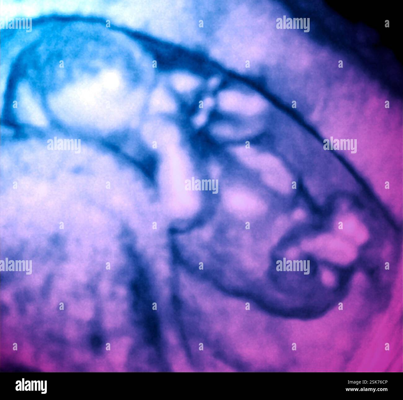 Thirteen week old foetus. Coloured 3-D ultrasound scan of a thirteen ...