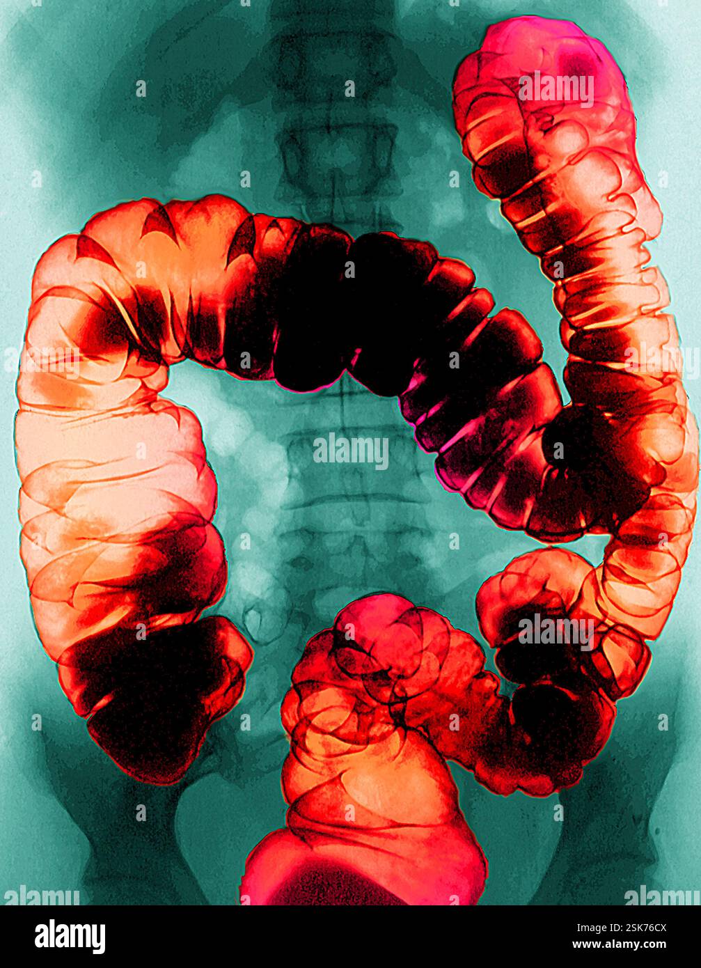 Healthy colon, coloured double contrast barium enema X-ray. The colon ...