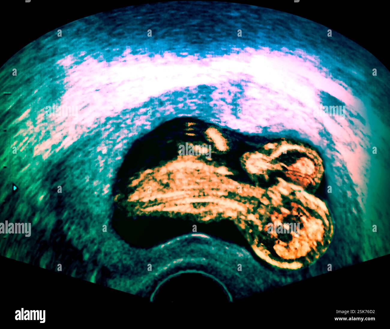 Twin foetuses. Coloured ultrasound scan of twin foetuses at 12 weeks ...