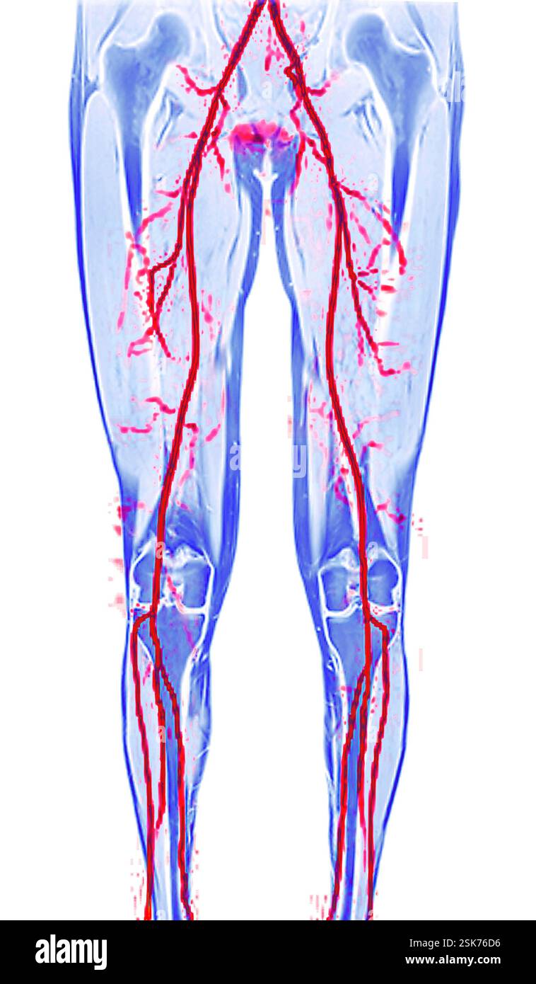 Leg arteries. Coloured magnetic resonance imaging (MRI) scan of normal ...