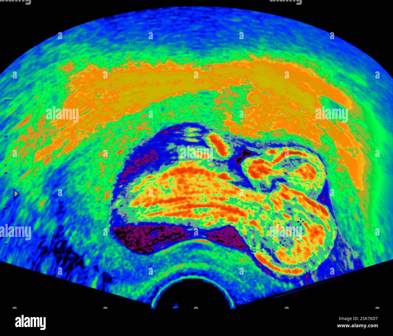 Twin foetuses, ultrasound scan Stock Photo - Alamy