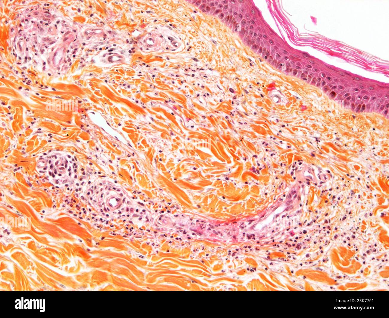 Hypersensitivity vasculitis. Light micrograph of a section through the ...
