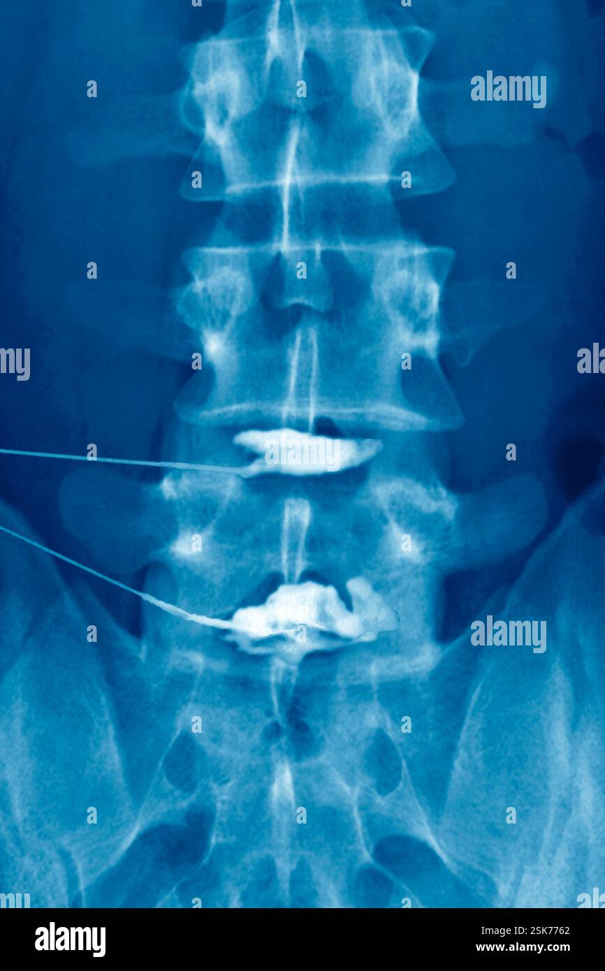 Slipped disc. Coloured frontal magnetic resonance imaging (MRI) scan of ...