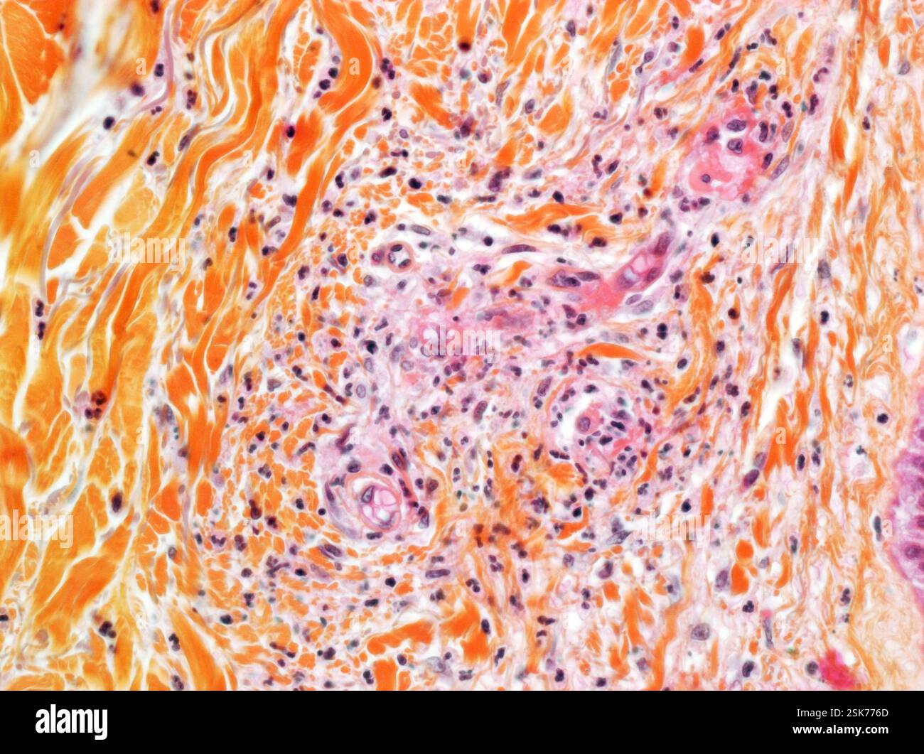 Hypersensitivity vasculitis. Light micrograph of a section through the ...