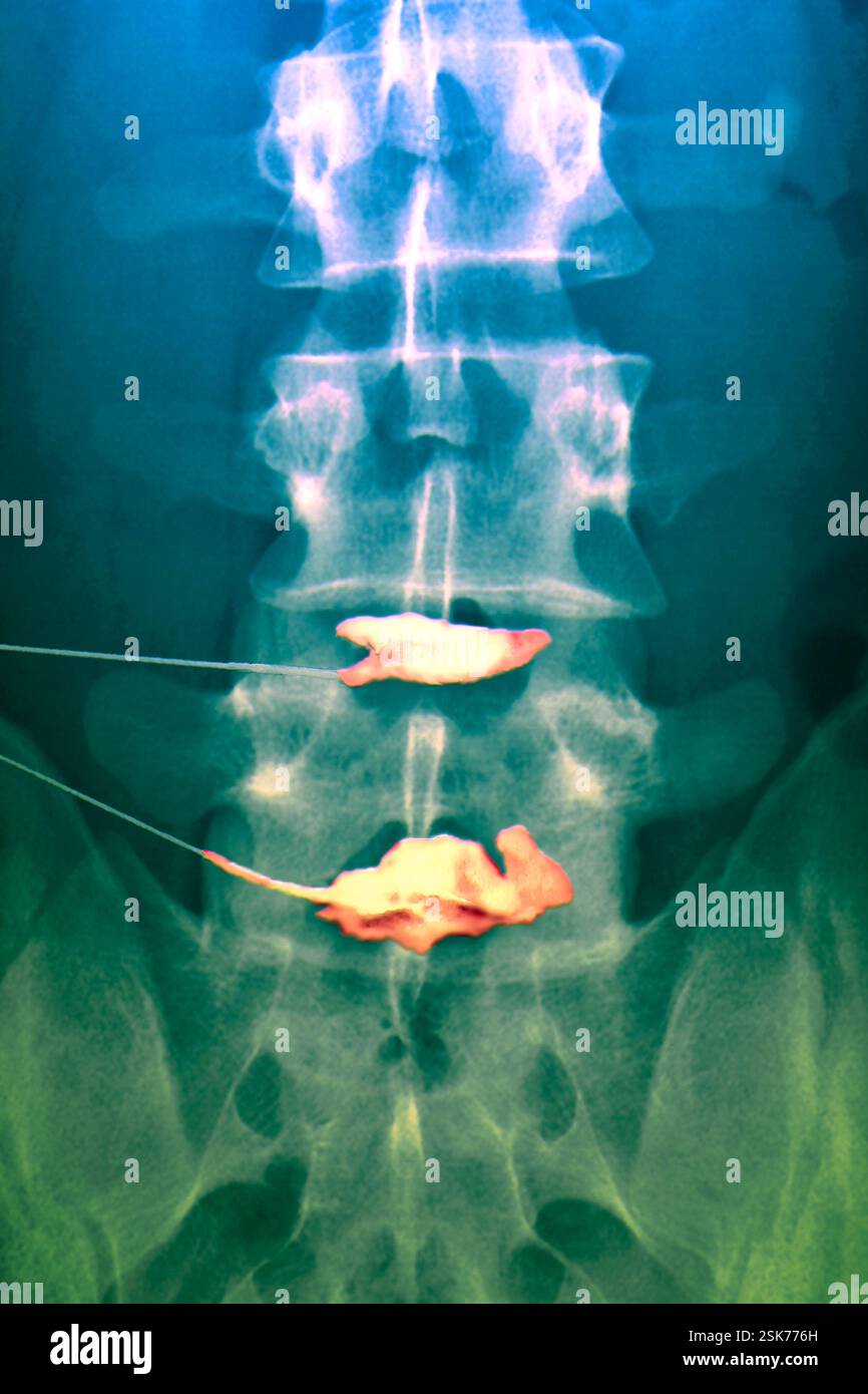 Slipped disc. Coloured frontal magnetic resonance imaging (MRI) scan of ...