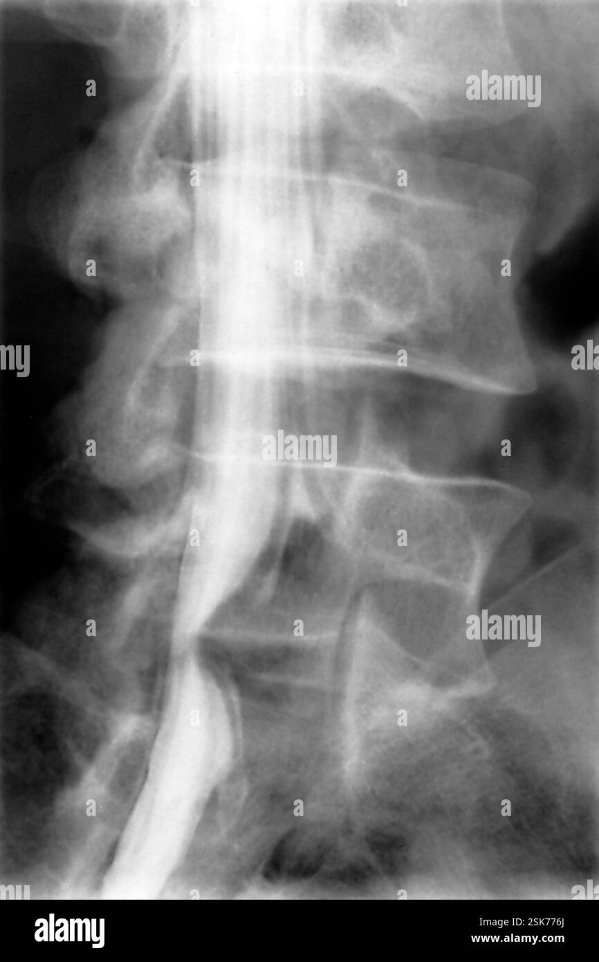 Slipped disc. Oblique myelogram (X-ray) of the lumbar spine showing a ...