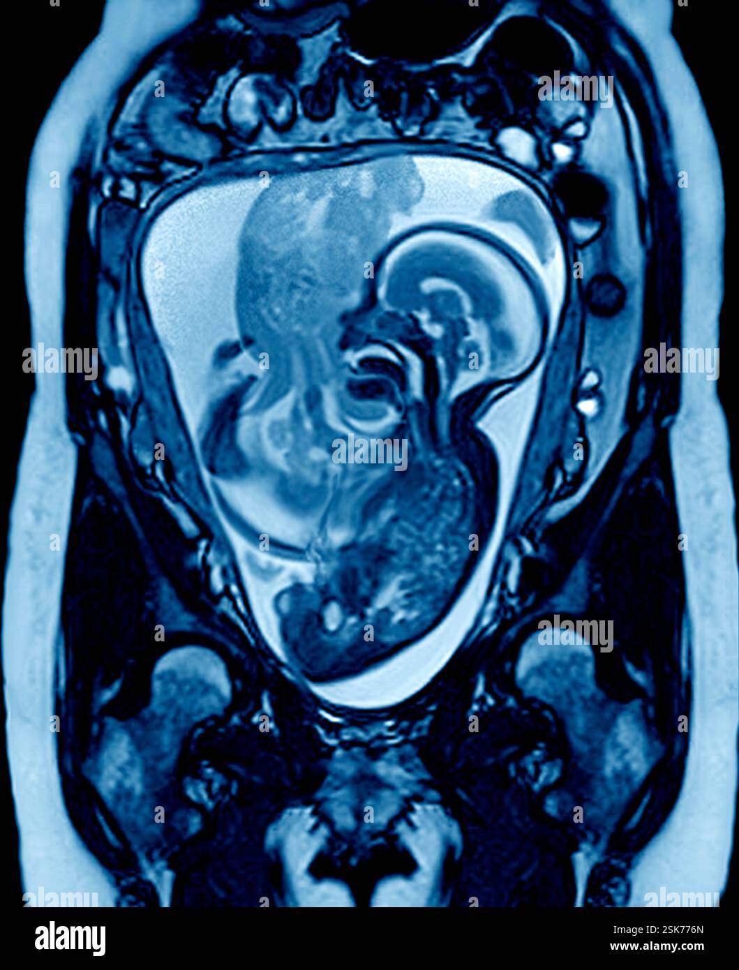 Twin foetuses. Coloured magnetic resonance imaging (MRI) scan of full ...