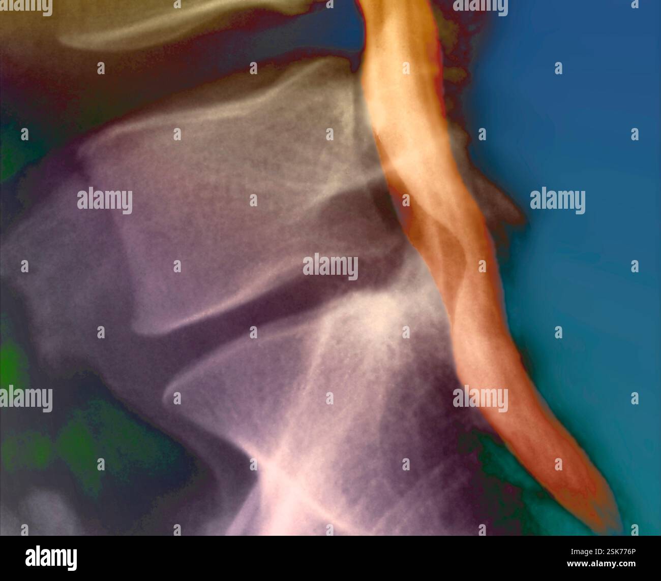 Slipped disc. Profile coloured myelogram (X-ray) of the lumbar spine ...