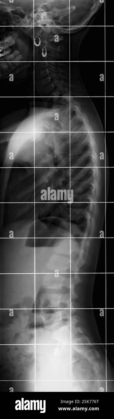 Normal spine. Profile X-ray of the normal spine of a 10 year old girl ...