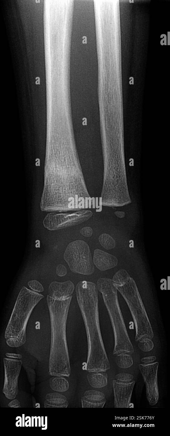 Healed fracture. X-ray of the lower arm and hand of an 8 year old after ...
